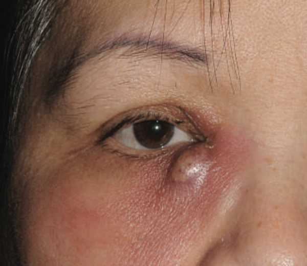 Dacriocistite bacteriana aguda: tratamento - Blog da Oftalmomaster